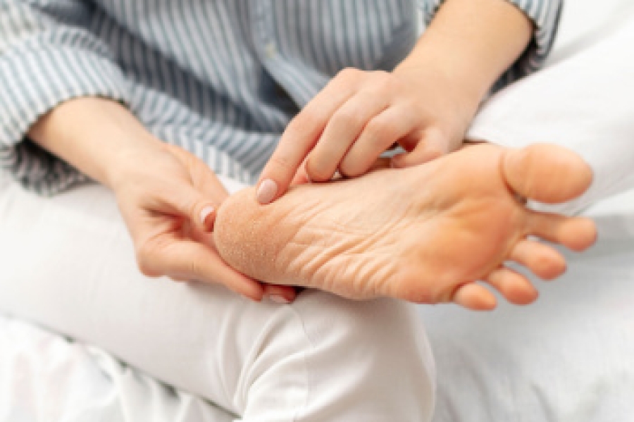 Cracked Heels May Be Linked to Nutritional Deficiencies